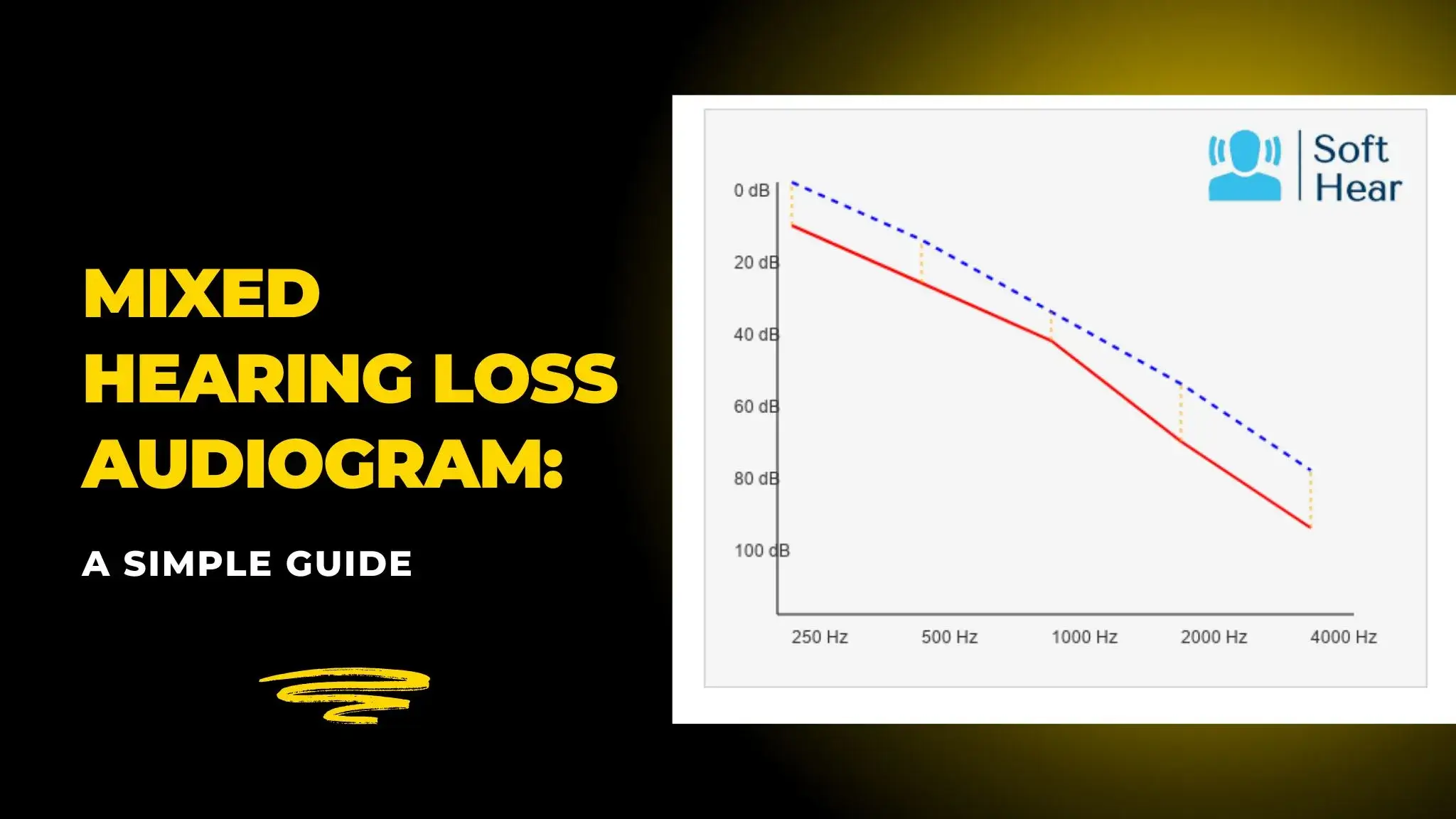 Mixed Hearing Loss Audiogram: A Simple Guide - Soft Hear Blogs
