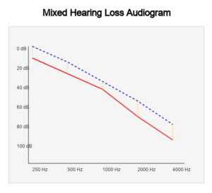 Mixed Hearing Loss Audiogram: A Simple Guide - Soft Hear Blogs
